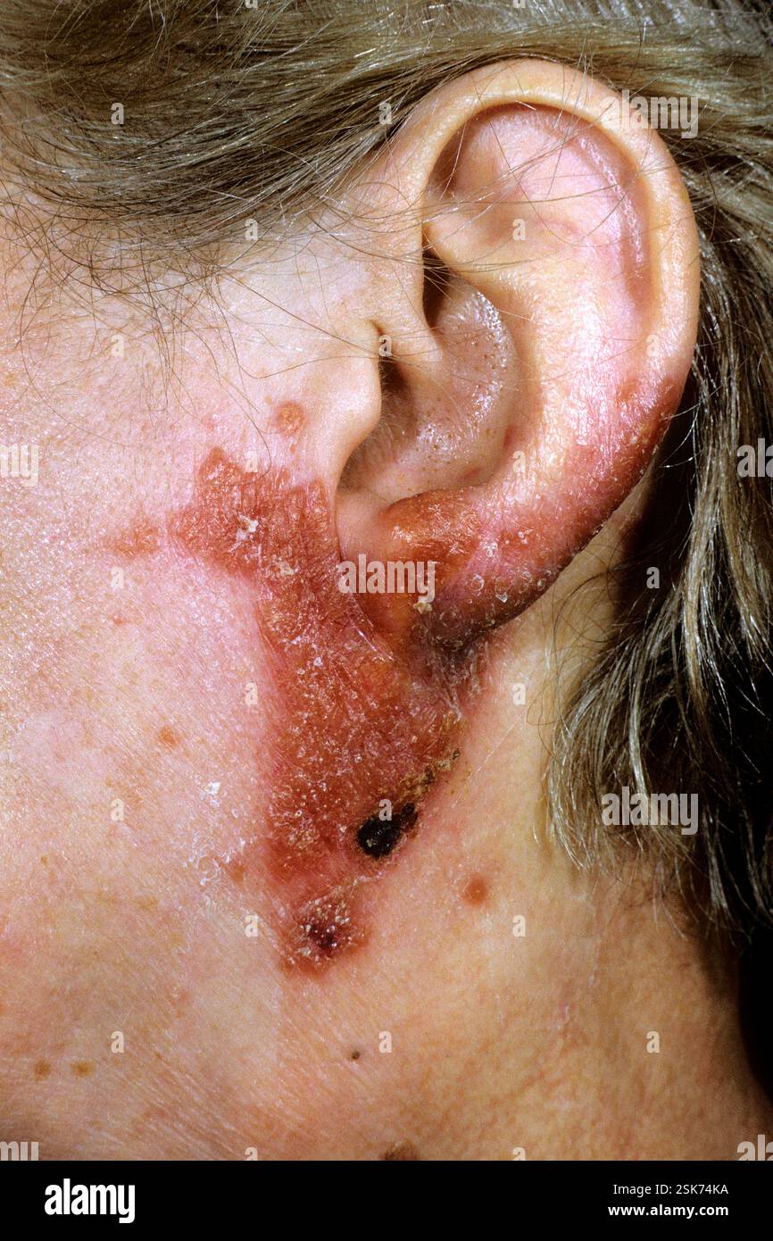 Tuberculosis on the face. Close-up of the ear of a 30-year-old female ...
