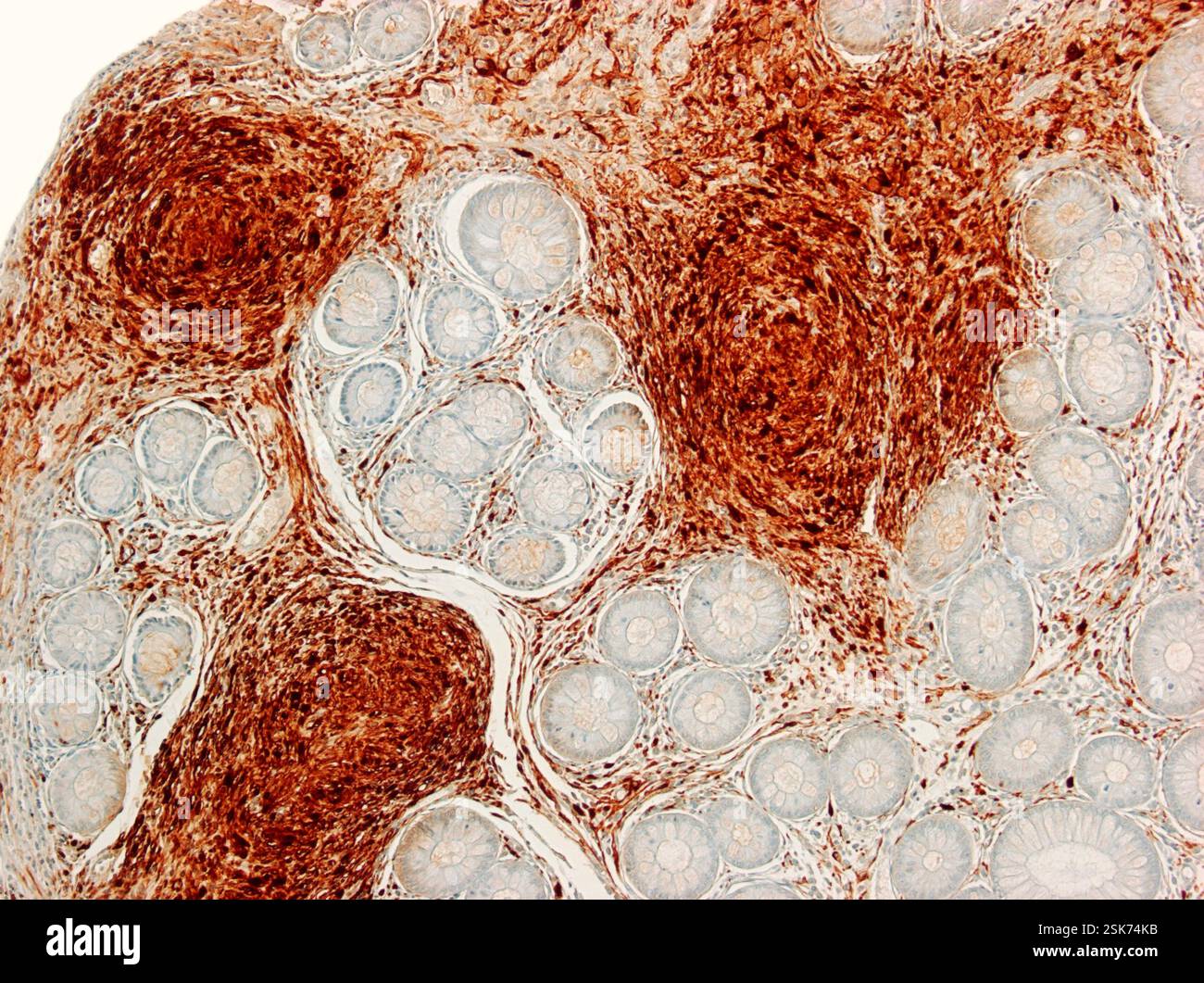 Osteoarthritis of the knee, MRI scan Stock Photo - Alamy