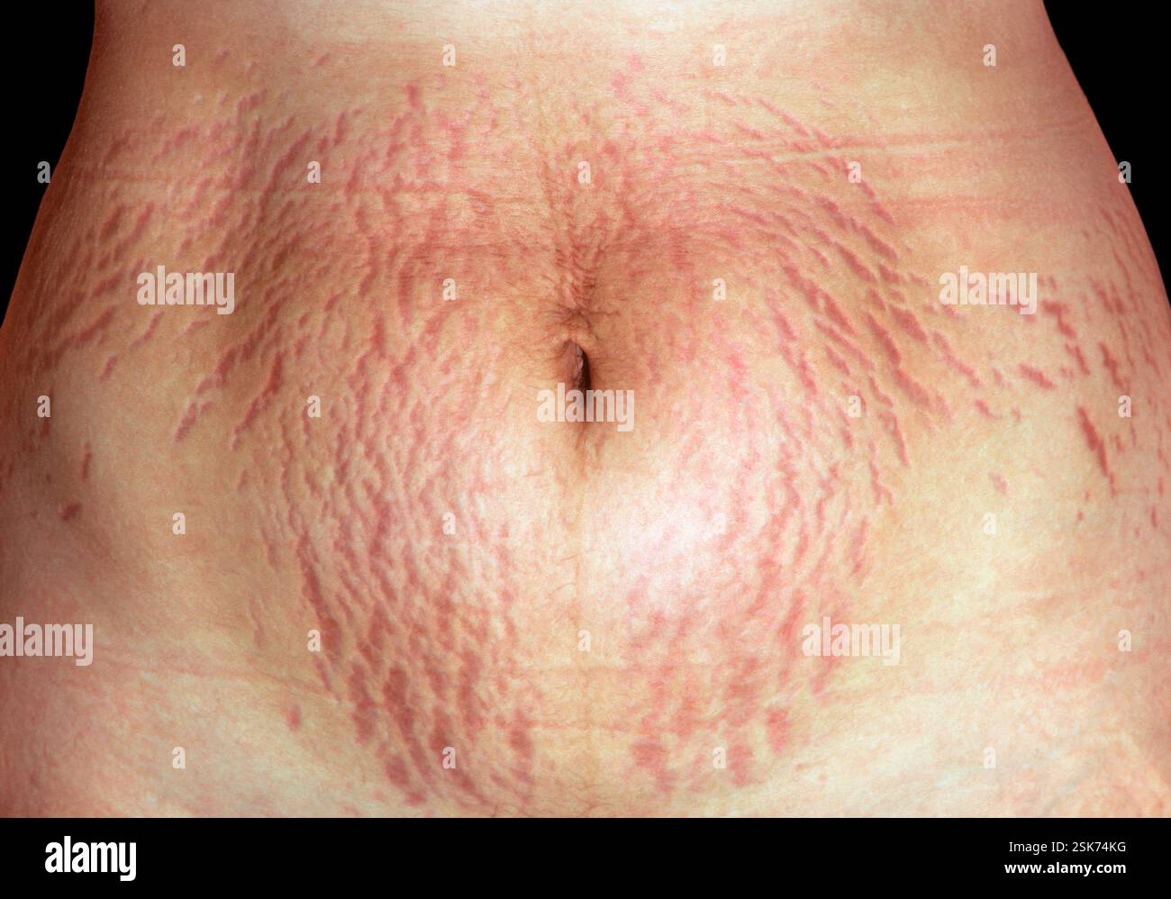 Stretch marks. Close-up of stretch marks (striae) on the abdomen of a ...
