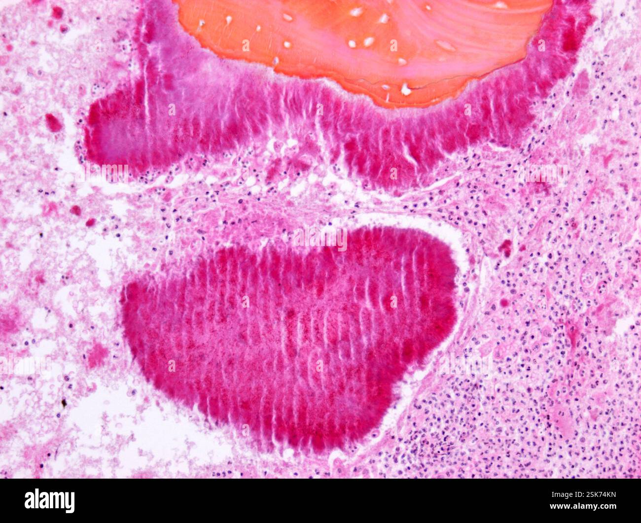 Actinomycosis bone infection. Light micrograph of a section through ...