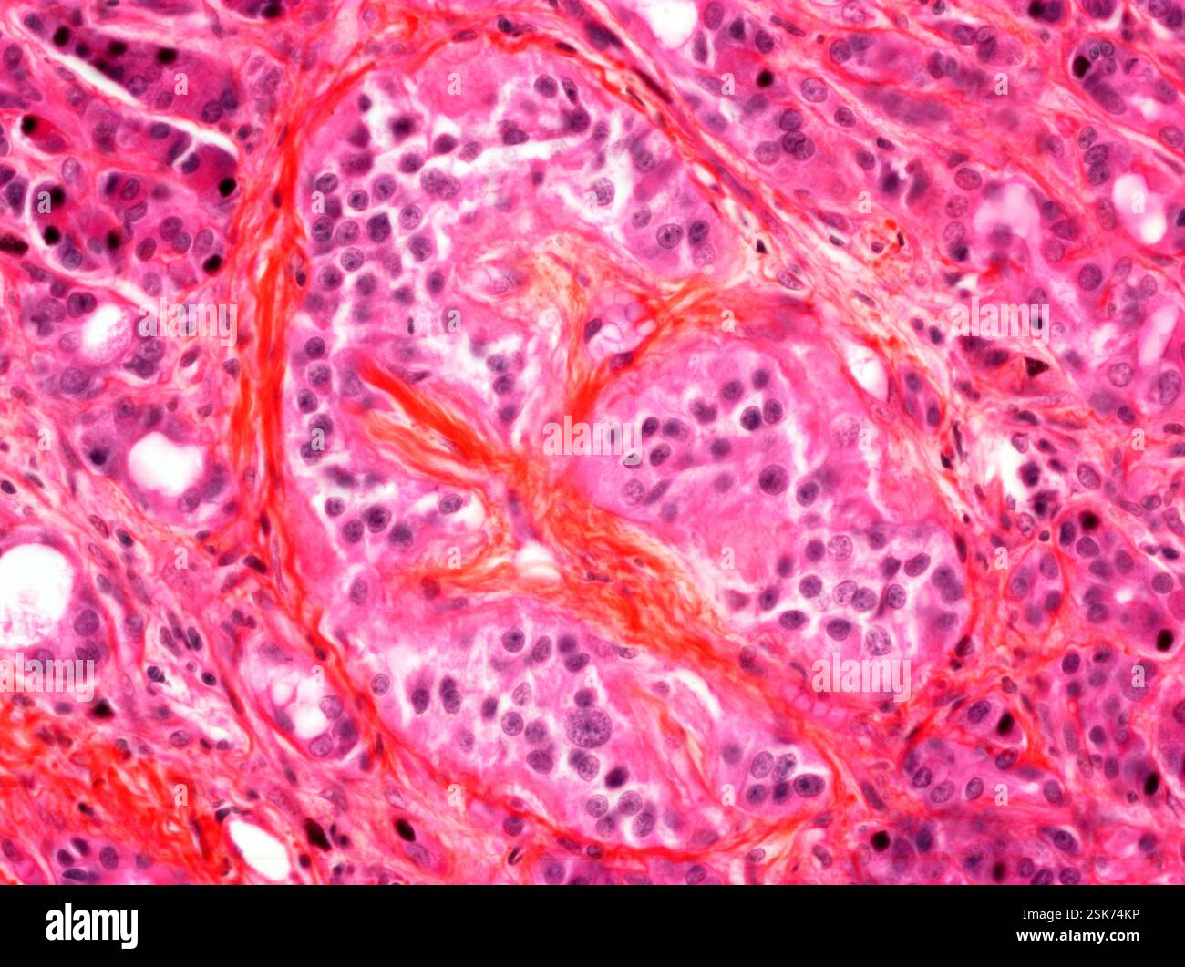 Amyloidosis in diabetes. Light micrograph of a section through an islet ...