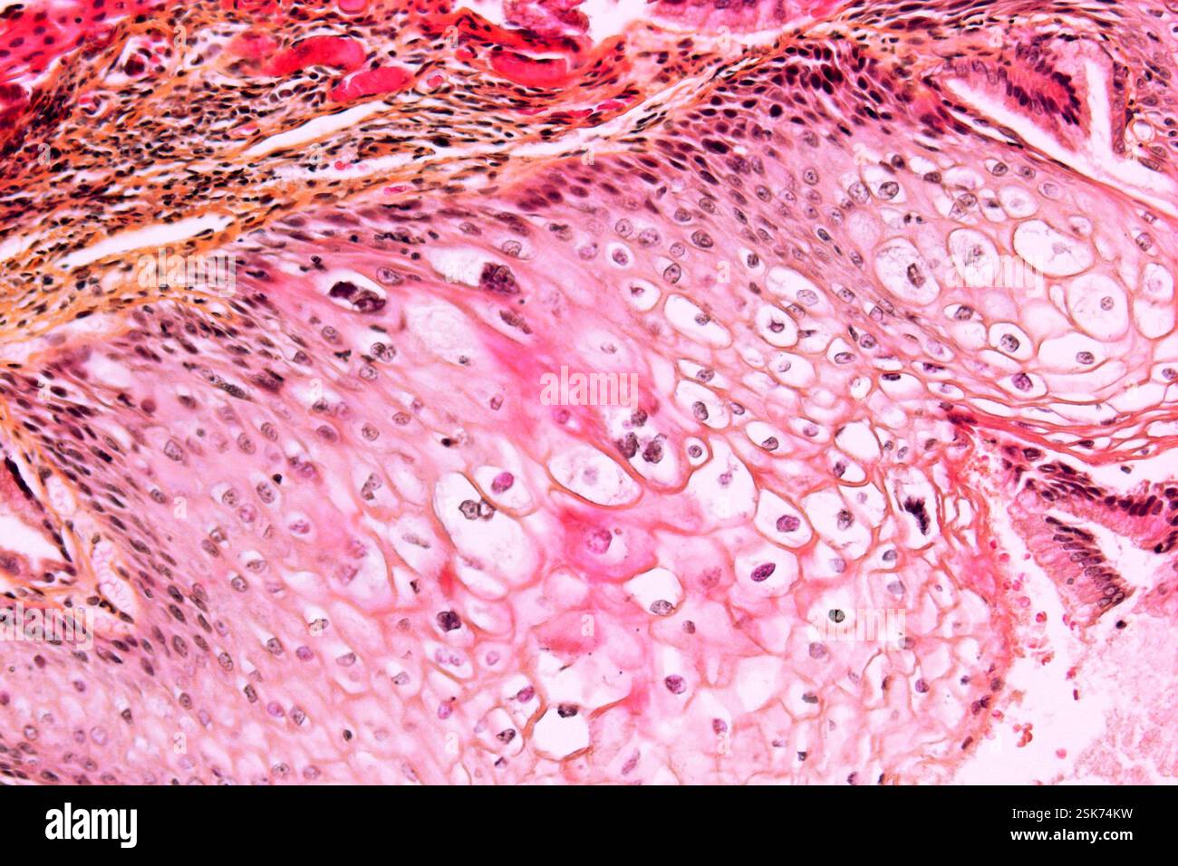 Cervical infection. Light micrograph of a section through the lining ...