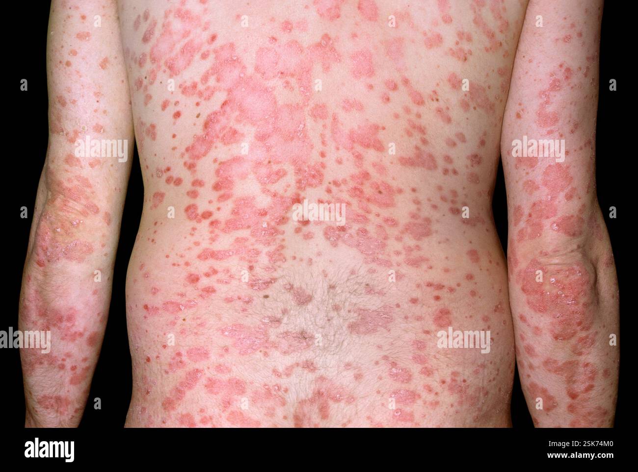 Guttate psoriasis. Close-up of lesions on the back and arms of a 50-year-old male patient with ...