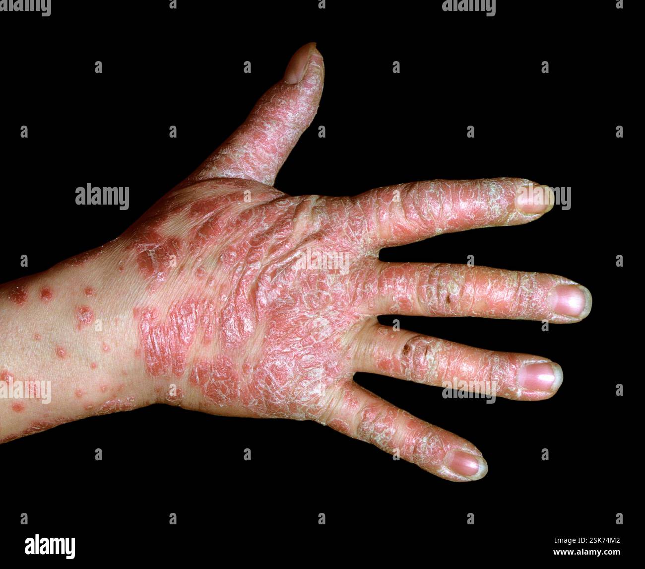 Psoriasis. Close-up of lesions on the hand of a 25-year-old male ...