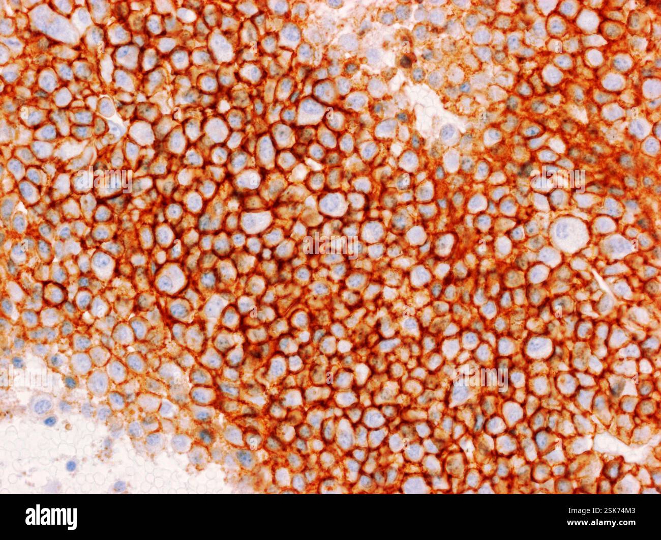 Skin in Reiter's syndrome Stock Photo - Alamy
