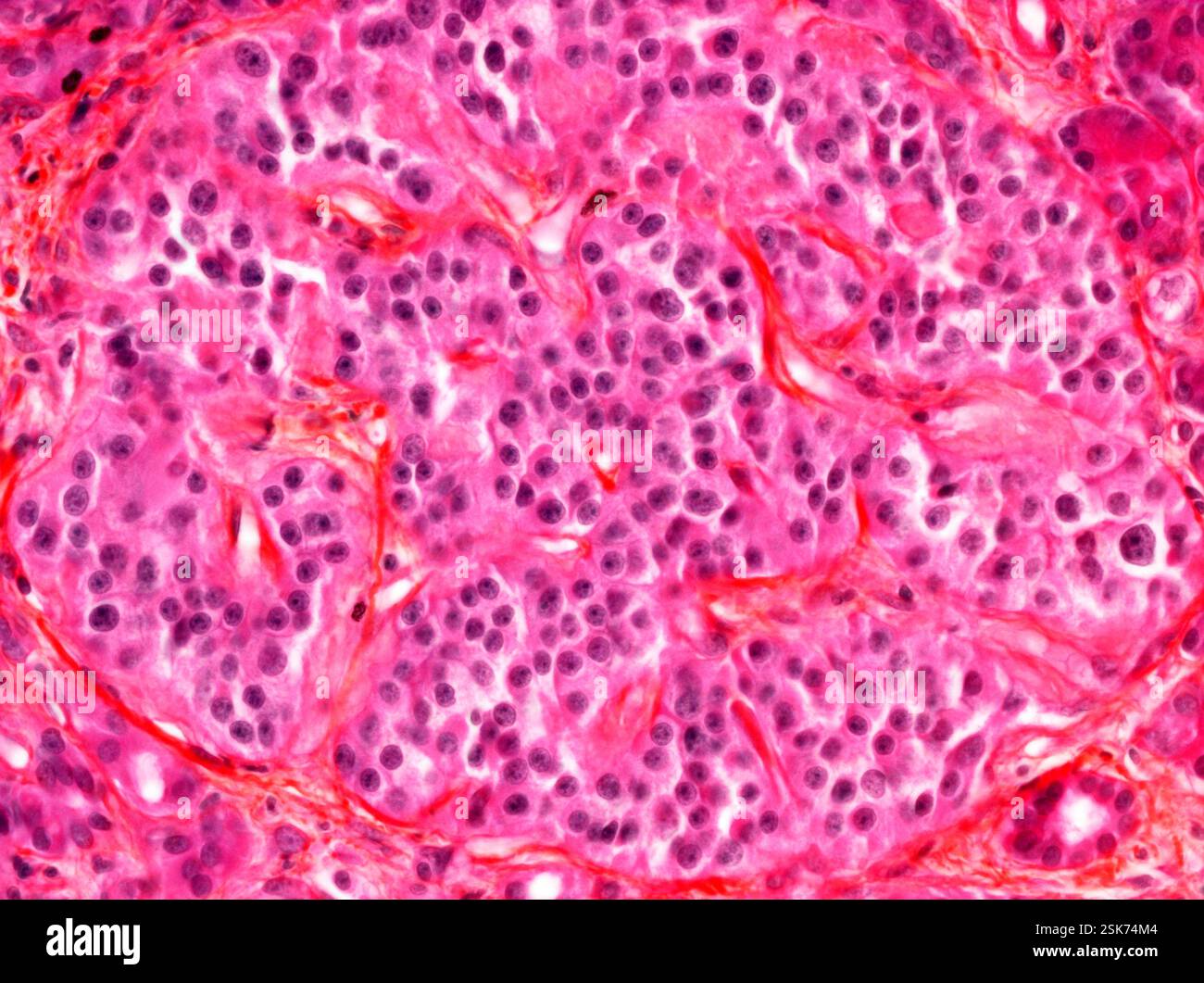 Amyloidosis in diabetes. Light micrograph of a section through an islet ...