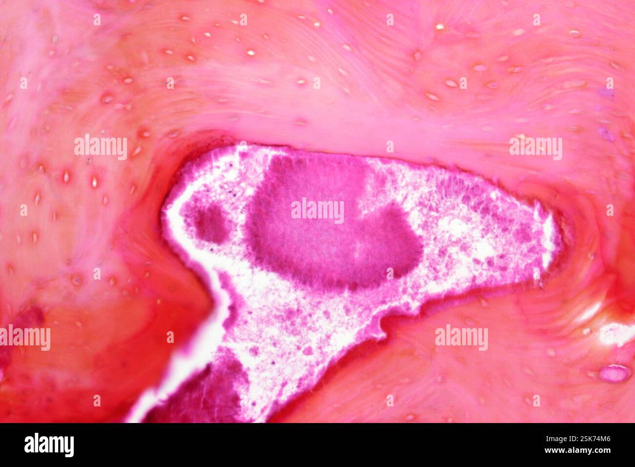 Actinomycosis bone infection. Light micrograph of a section through ...