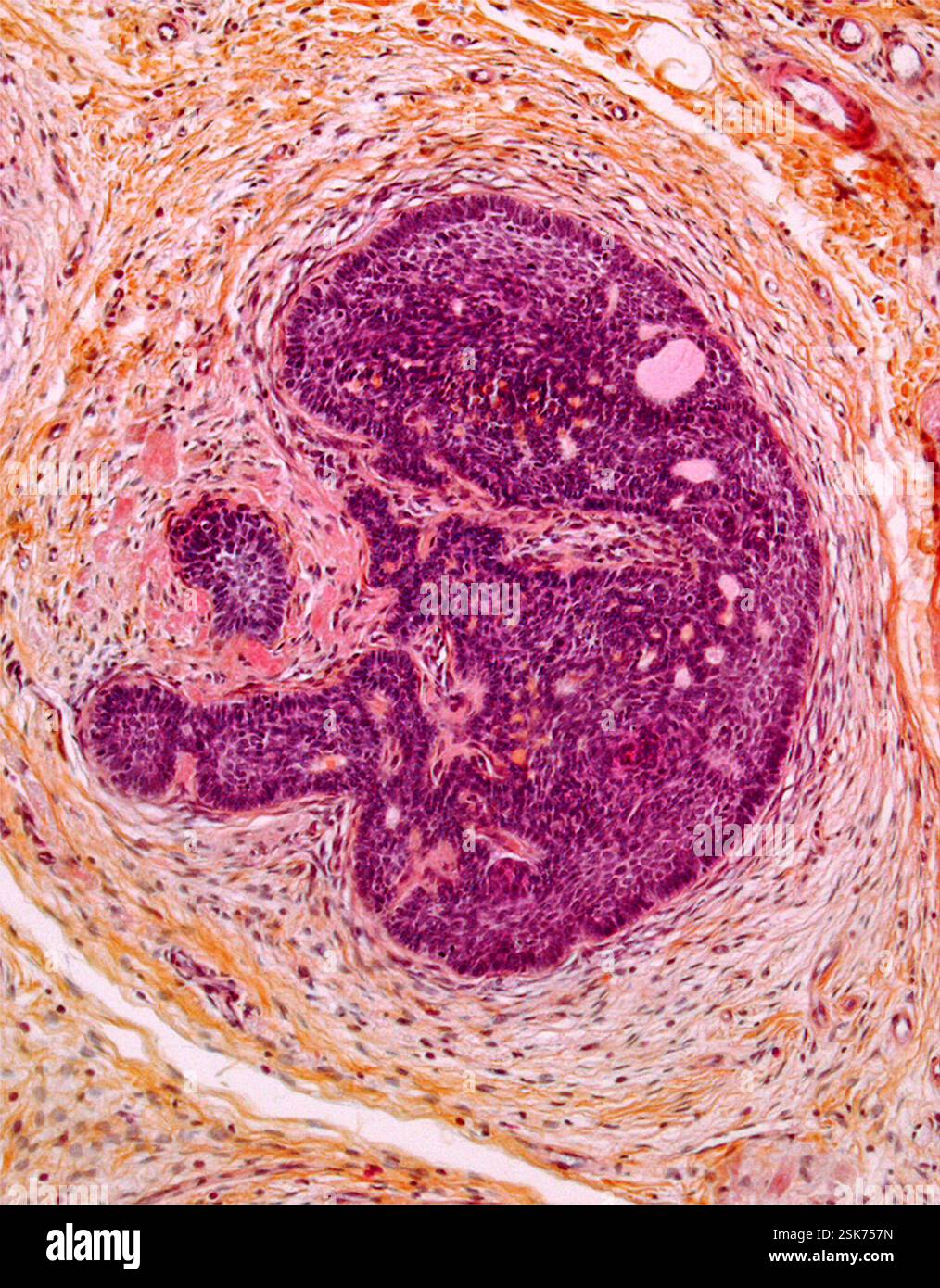 Skin cancer. Light micrograph of a section through a basal cell ...