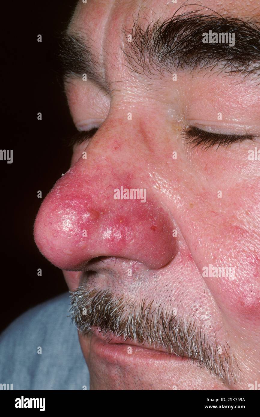 Rhinophyma. Close-up of the bulbous and reddened nose of a 73-year-old ...