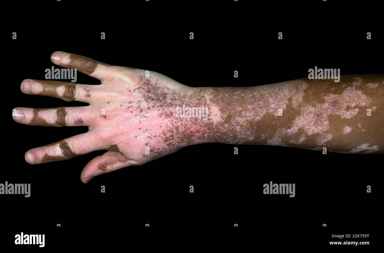 Vitiligo. Lesions on the hand and arm of a 31-year-old male patient ...