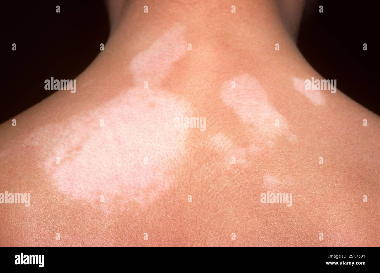 Vitiligo. Lesions on the neck and back of a 24-year-old female patient ...