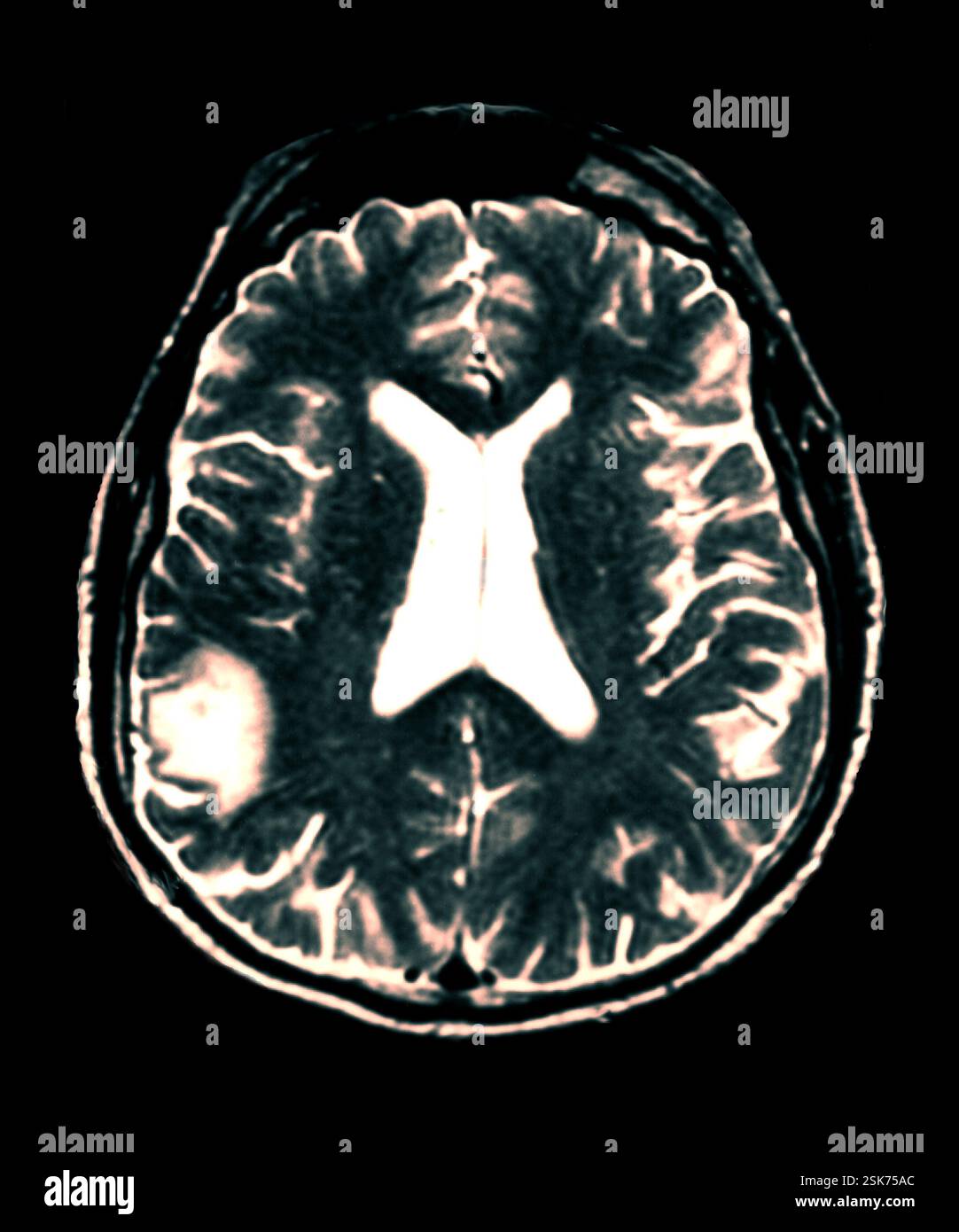Stent in neck artery, X-ray Stock Photo - Alamy