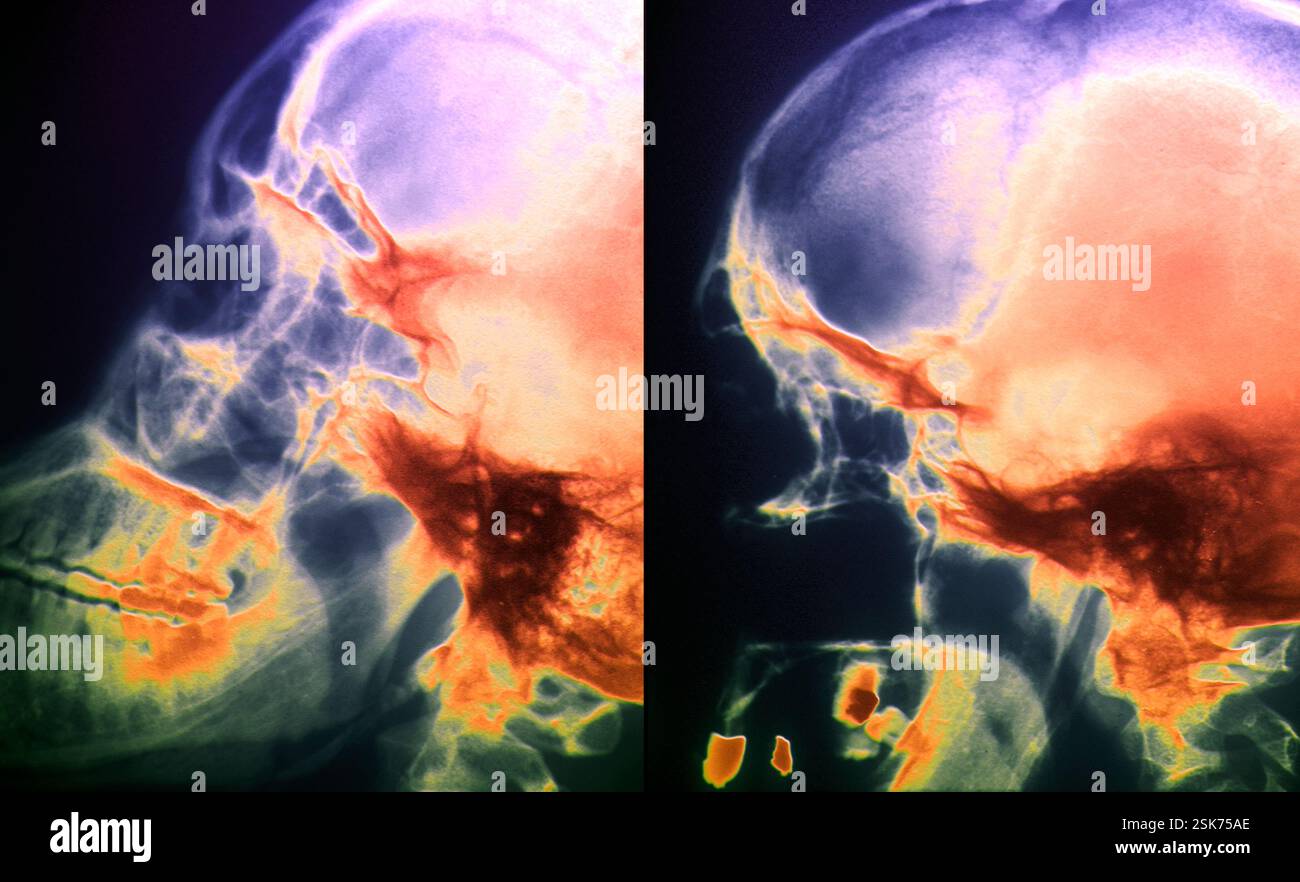 Stent in neck artery, X-ray Stock Photo - Alamy
