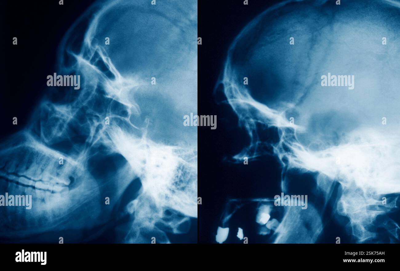 Stent in neck artery, X-ray Stock Photo - Alamy