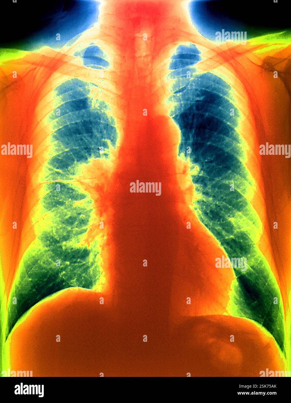 Thrombosis of leg arteries, MRI scan Stock Photo - Alamy