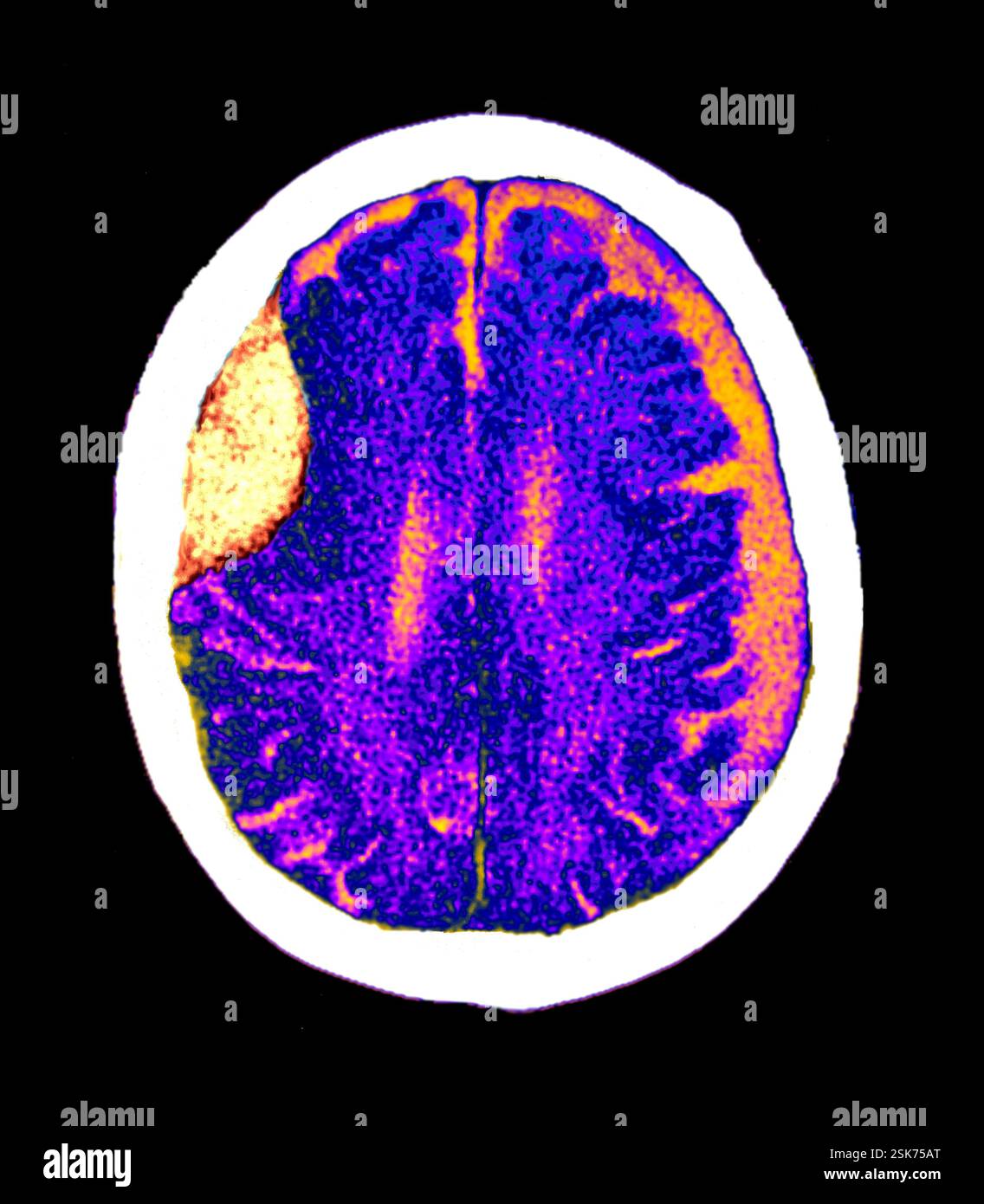 Encysted pleurisy, X-ray Stock Photo - Alamy