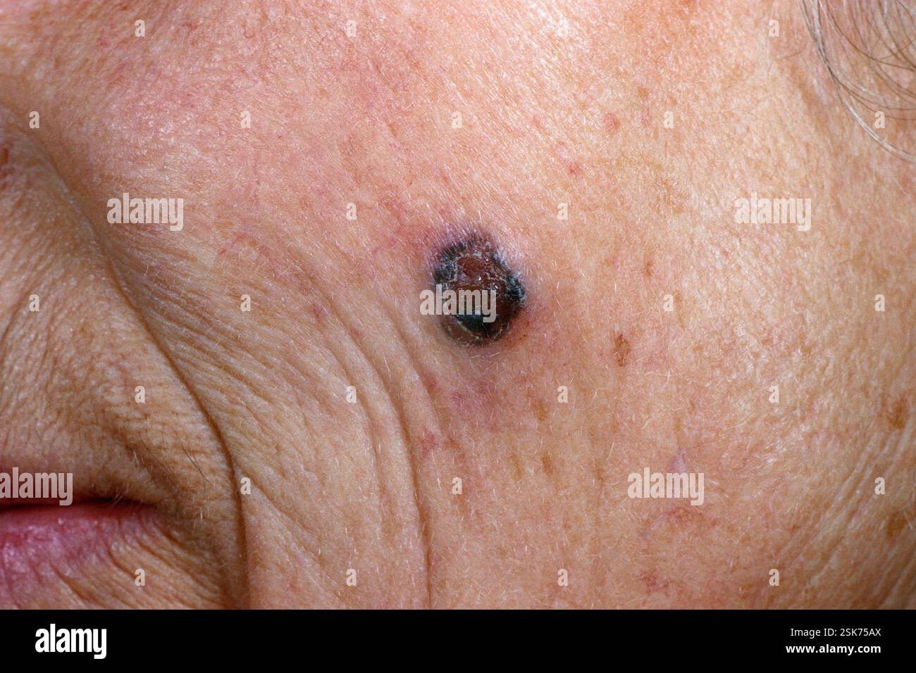 Melanoma skin cancer. Close-up of a malignant (cancerous) melanoma on ...