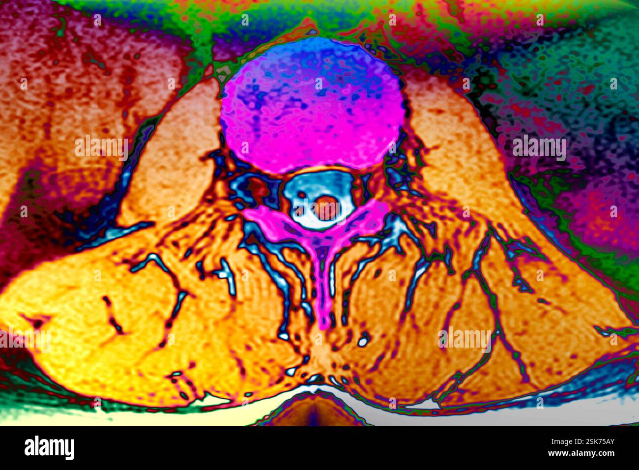 Arachnoiditis. Coloured magnetic resonance imaging (MRI) scan of a ...