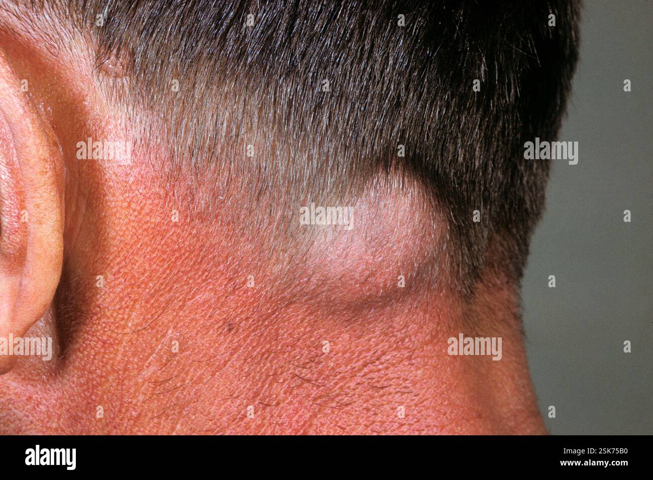 Secondary lymph node cancer. Close-up of malignant (cancerous) tumour ...