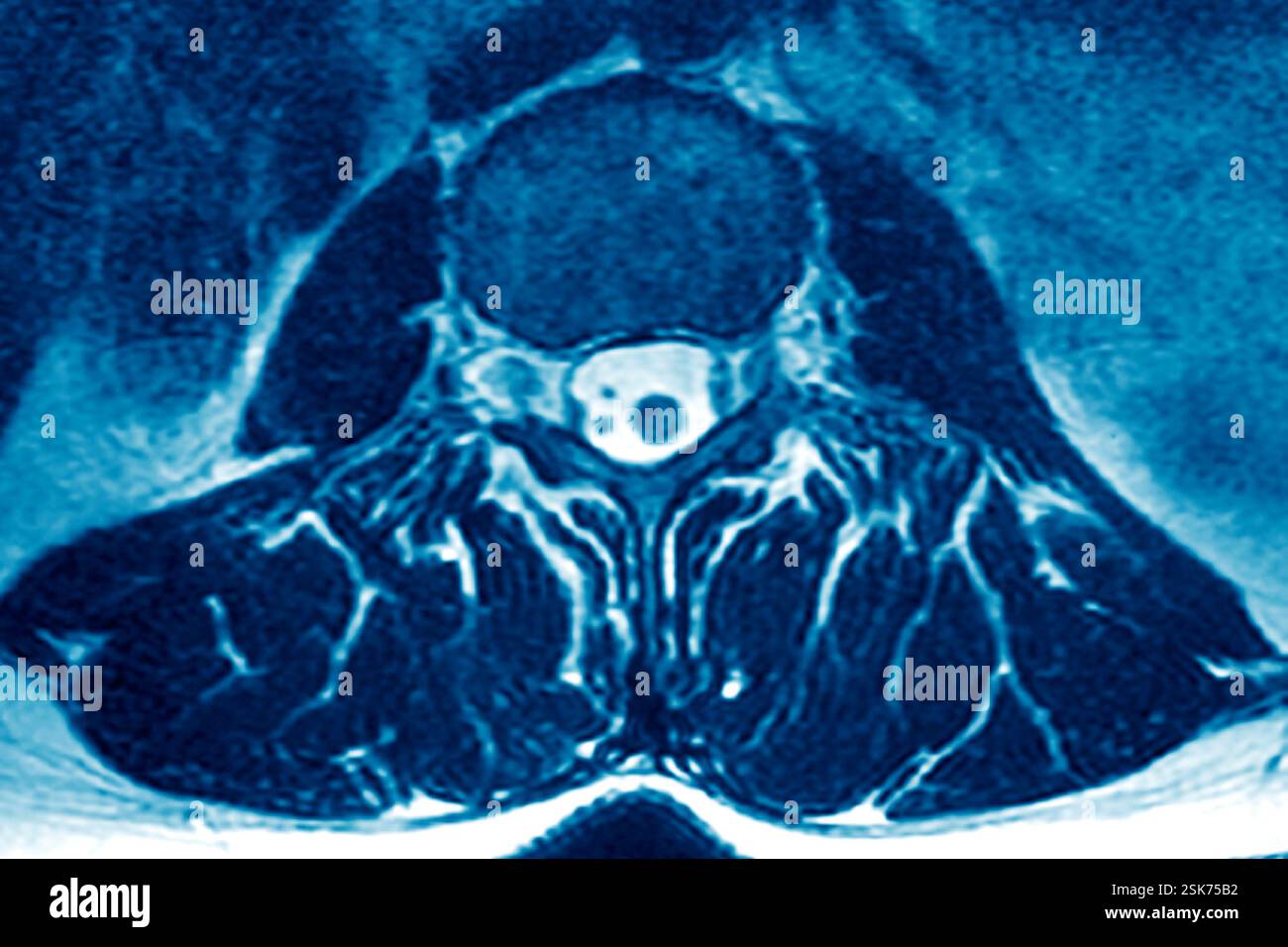 Arachnoiditis. Coloured magnetic resonance imaging (MRI) scan of a ...