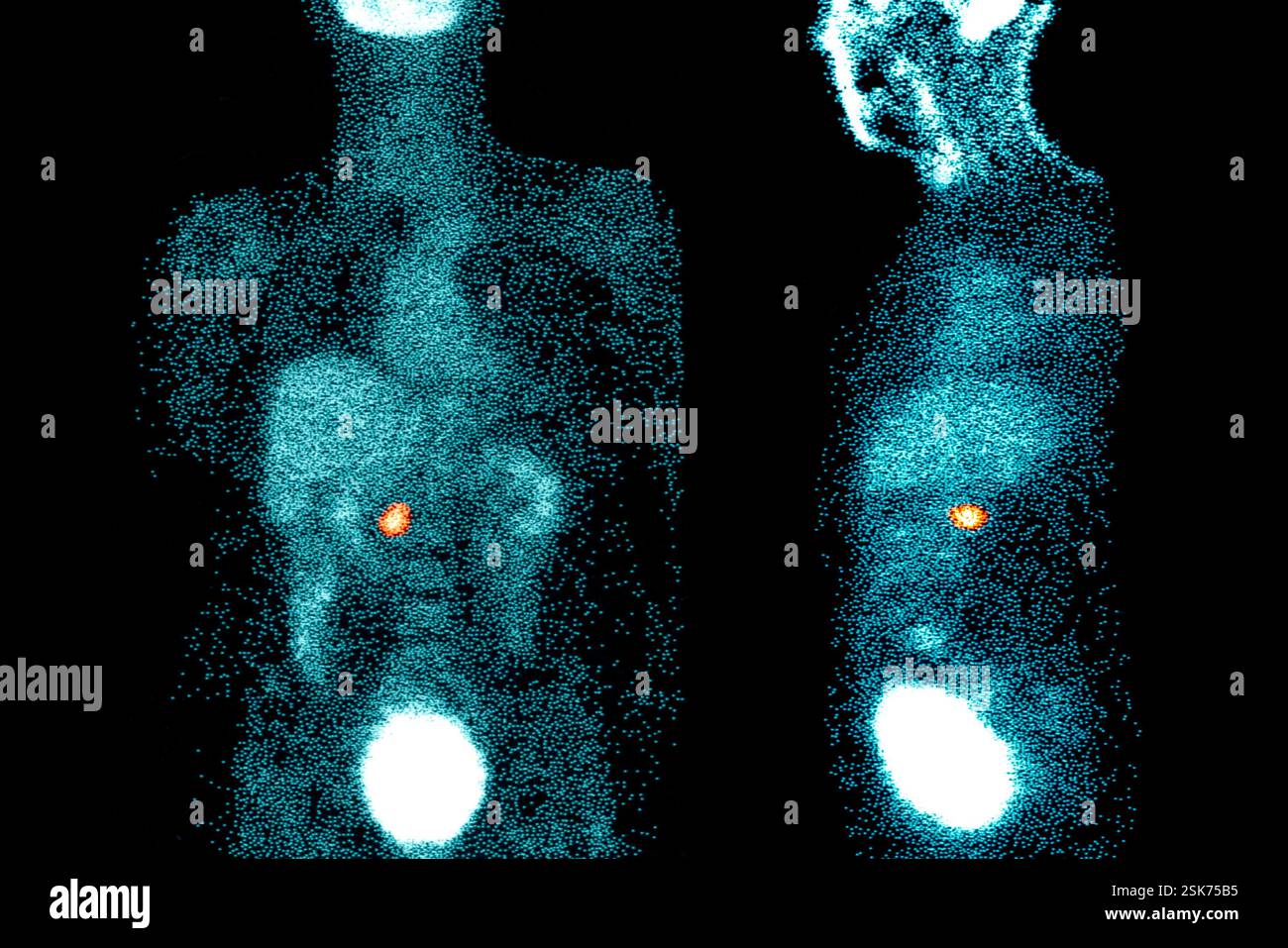 Secondary bone cancer. Coloured frontal (left) and sagittal (right ...