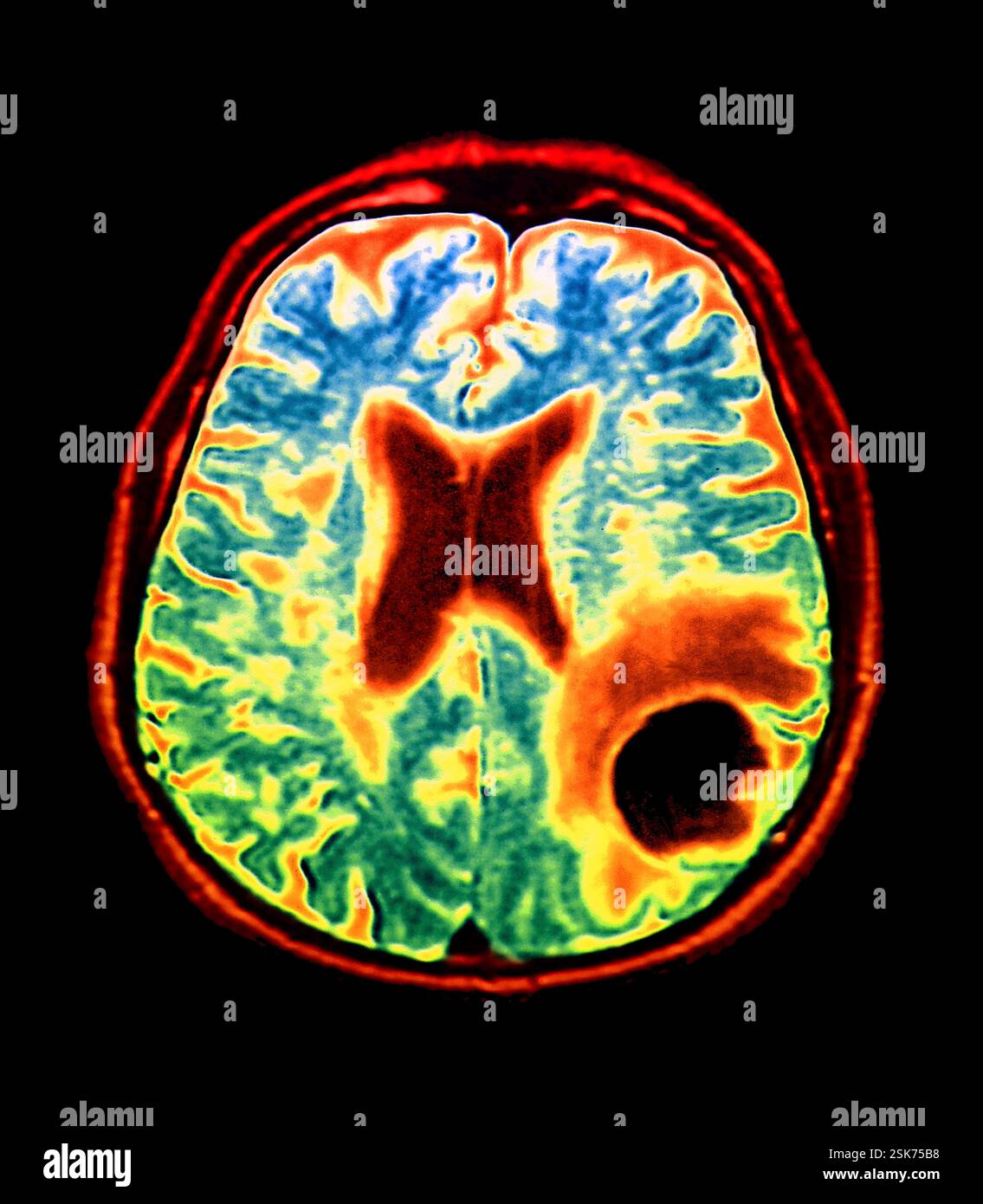 Thrombosis of leg arteries, MRI scan Stock Photo - Alamy