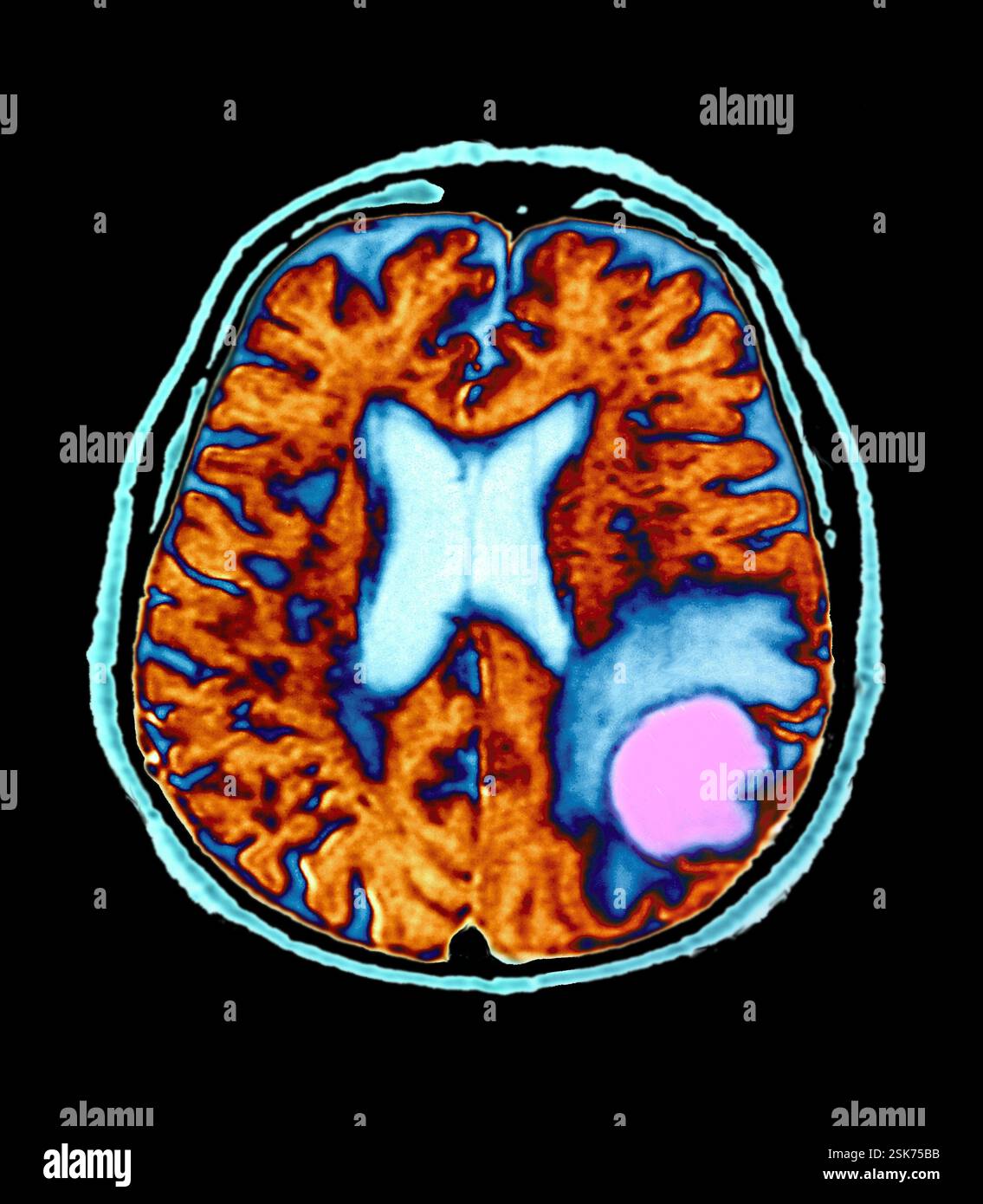 Thrombosis of leg arteries, MRI scan Stock Photo - Alamy