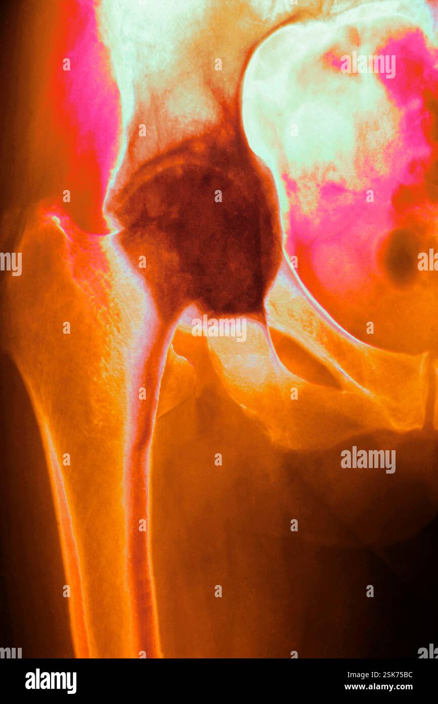 Arthritic hip. Coloured frontal X-ray of the hip of a patient with ...