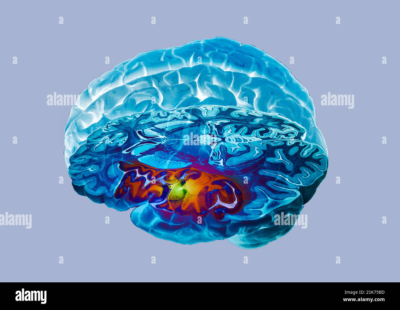 Stroke. Coloured three-dimensional magnetic resonance imaging (MRI) scan of the brain of a 65 ...