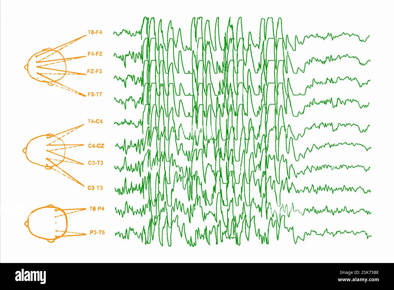 Brain waves in epilepsy. Electroencephalogram (EEG) of a 17-year-old's ...