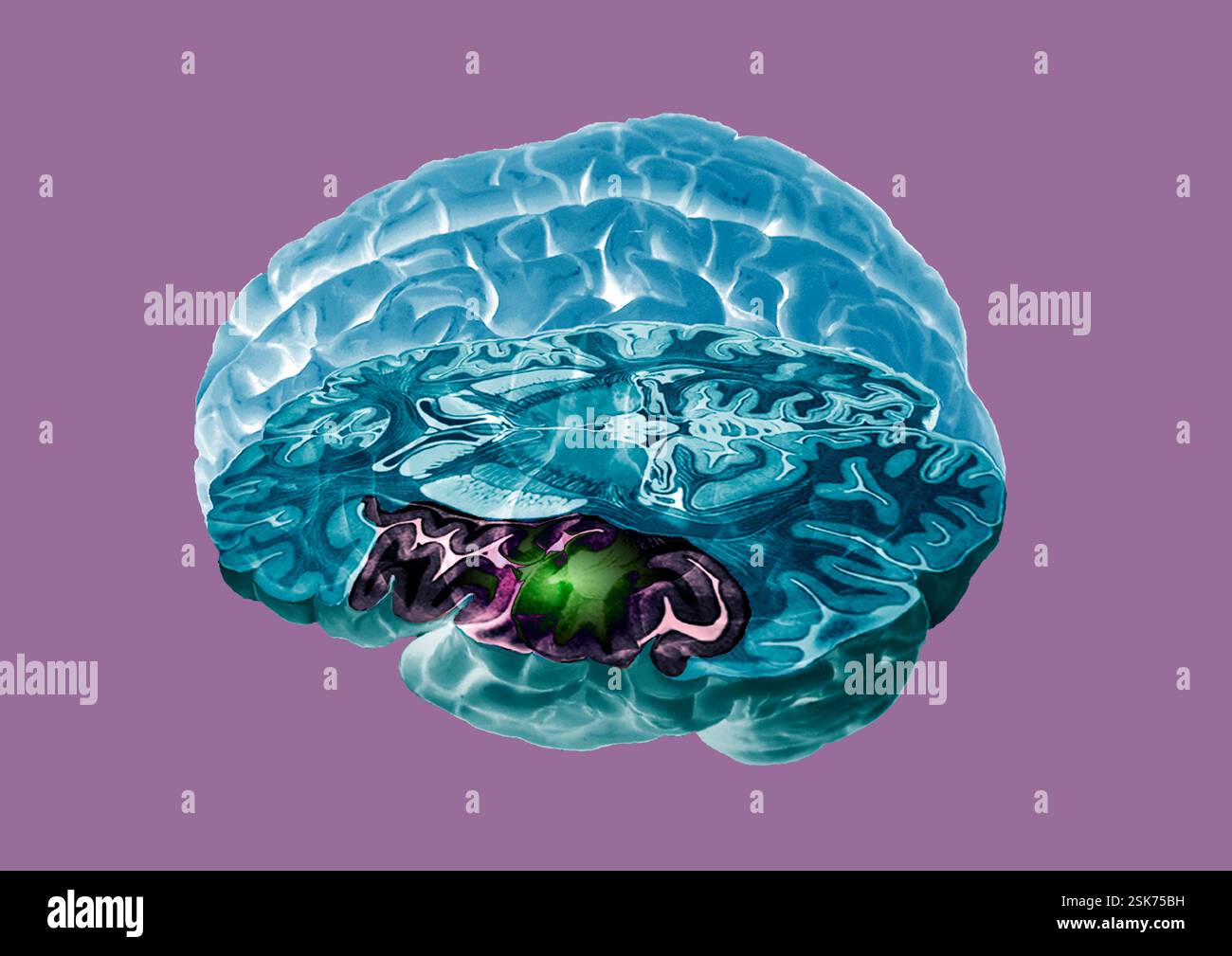 Stroke. Coloured three-dimensional magnetic resonance imaging (MRI ...