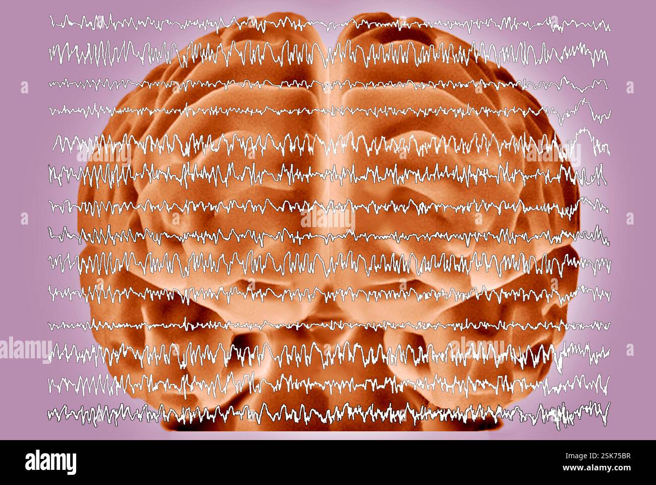 Brain and brain waves in epilepsy. 3D magnetic resonance imaging (MRI ...