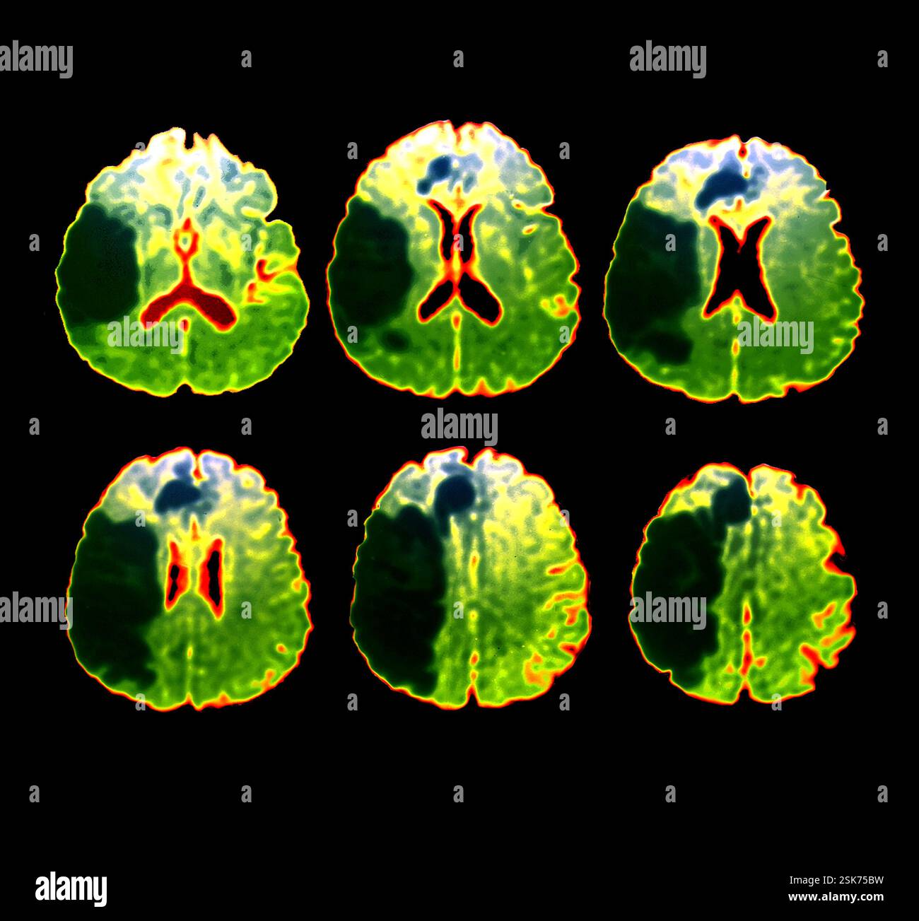 Nasal polyp, 3D CT scan Stock Photo - Alamy