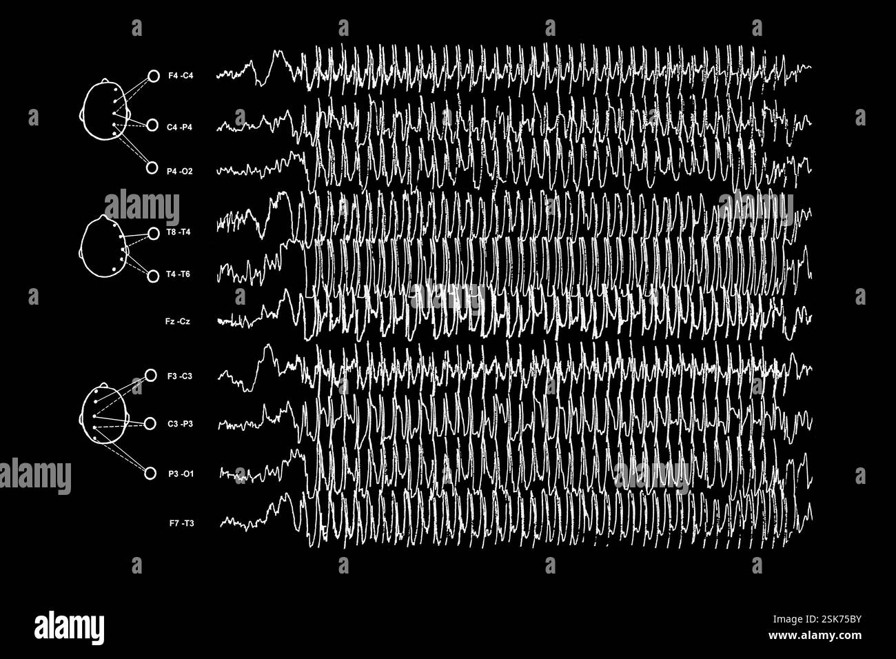 Brain waves in epilepsy. Electroencephalogram (EEG) of a 6-year-old ...