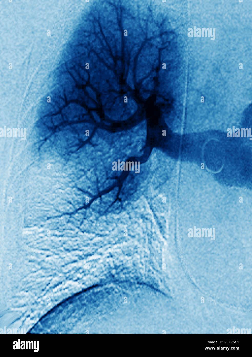 Blocked fallopian tubes, X-ray Stock Photo - Alamy