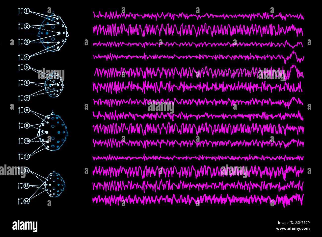 Brain waves in epilepsy. Electroencephalogram (EEG) of a 62-year-old's brain during an epileptic ...