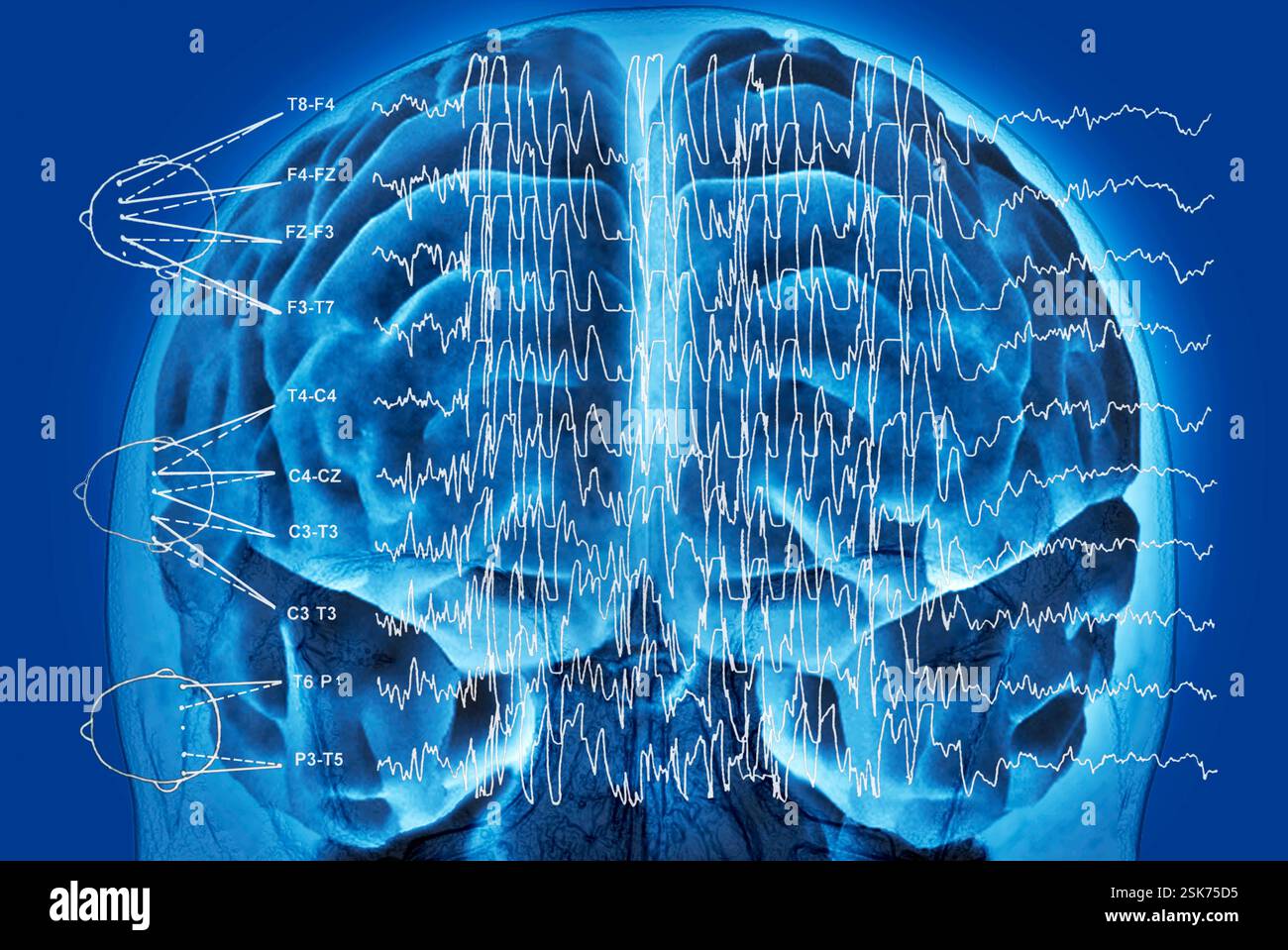 Slipped discs, MRI scan Stock Photo - Alamy