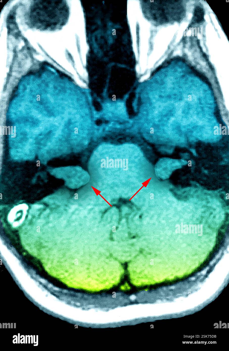 Healthy colon, barium X-ray Stock Photo - Alamy