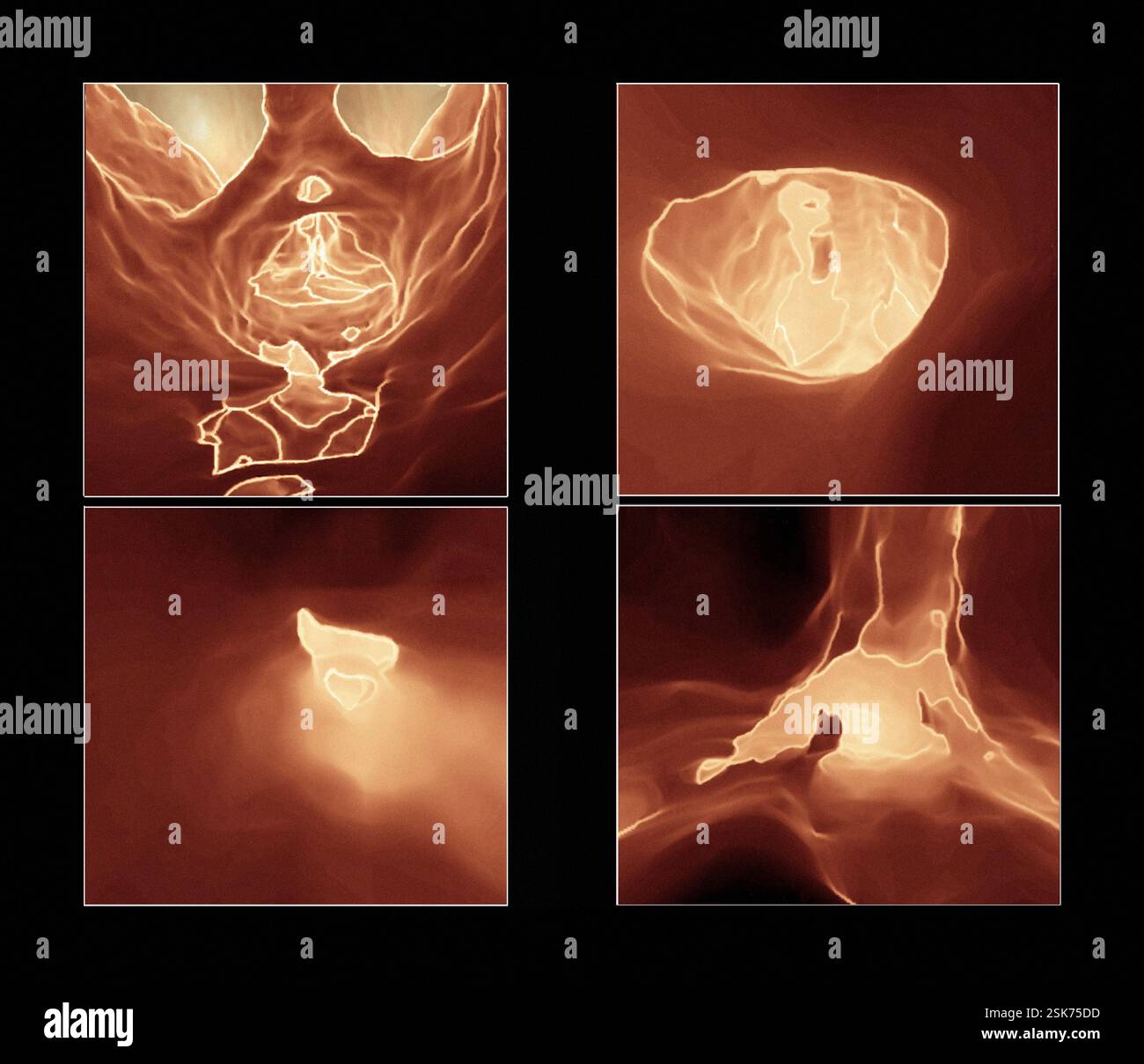Artificial hips, X-ray Stock Photo - Alamy