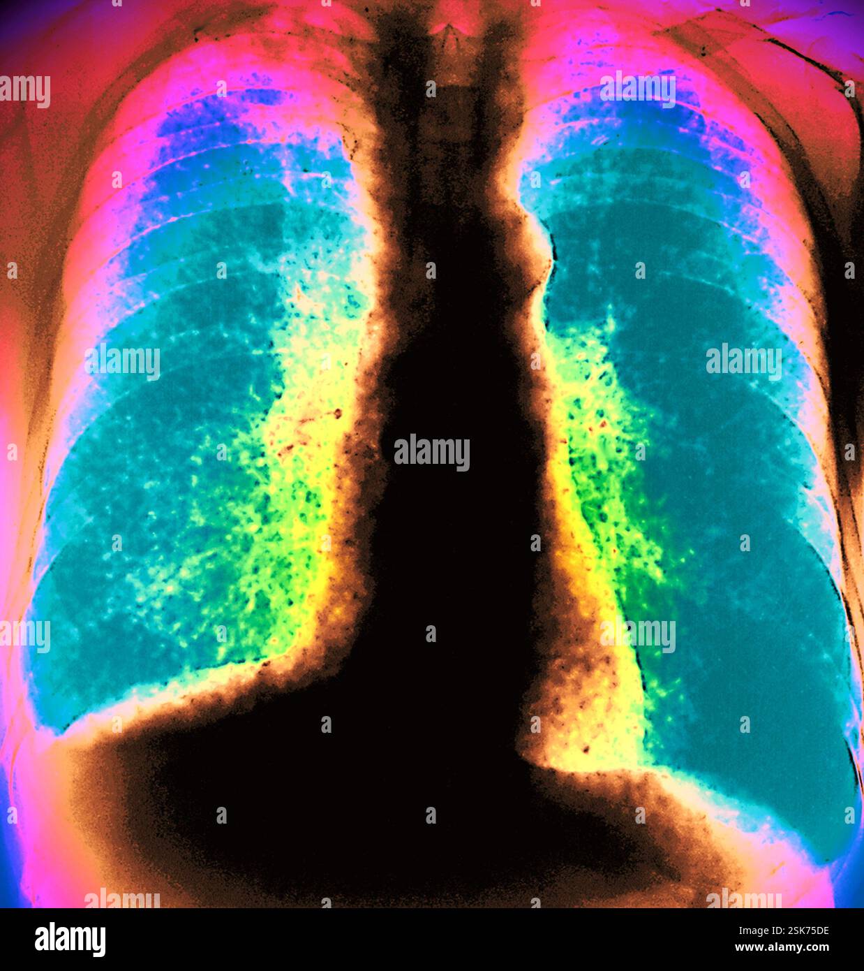 Miliary tuberculosis. Coloured frontal chest X-ray of the lungs of a ...