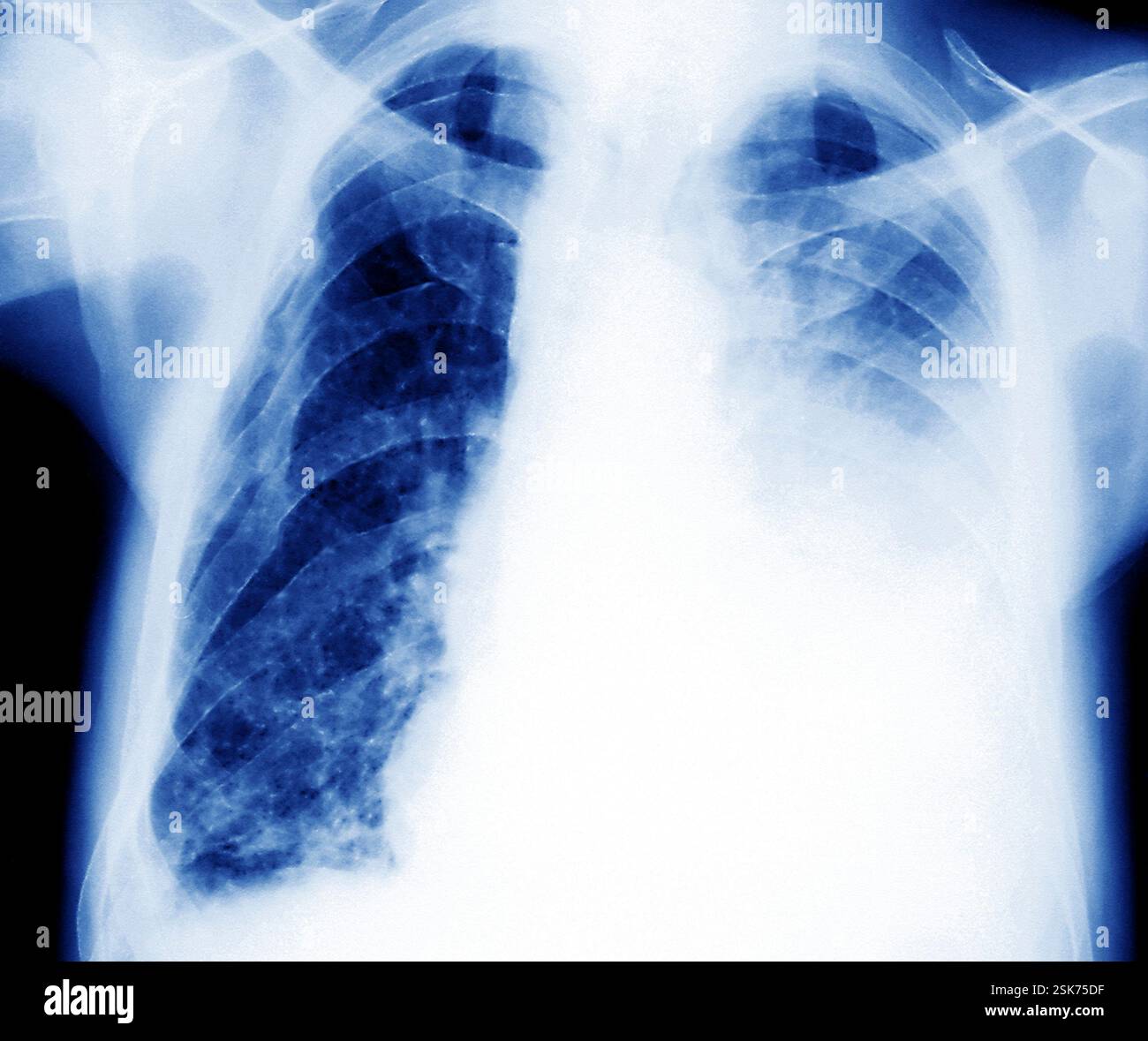 Healthy appendix, barium enema X-ray Stock Photo - Alamy