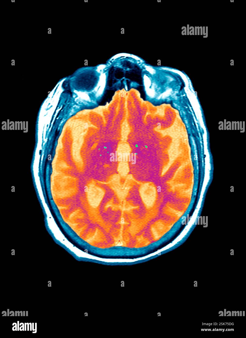 Microlacunae. Coloured magnetic resonance imaging scan of the brain of ...