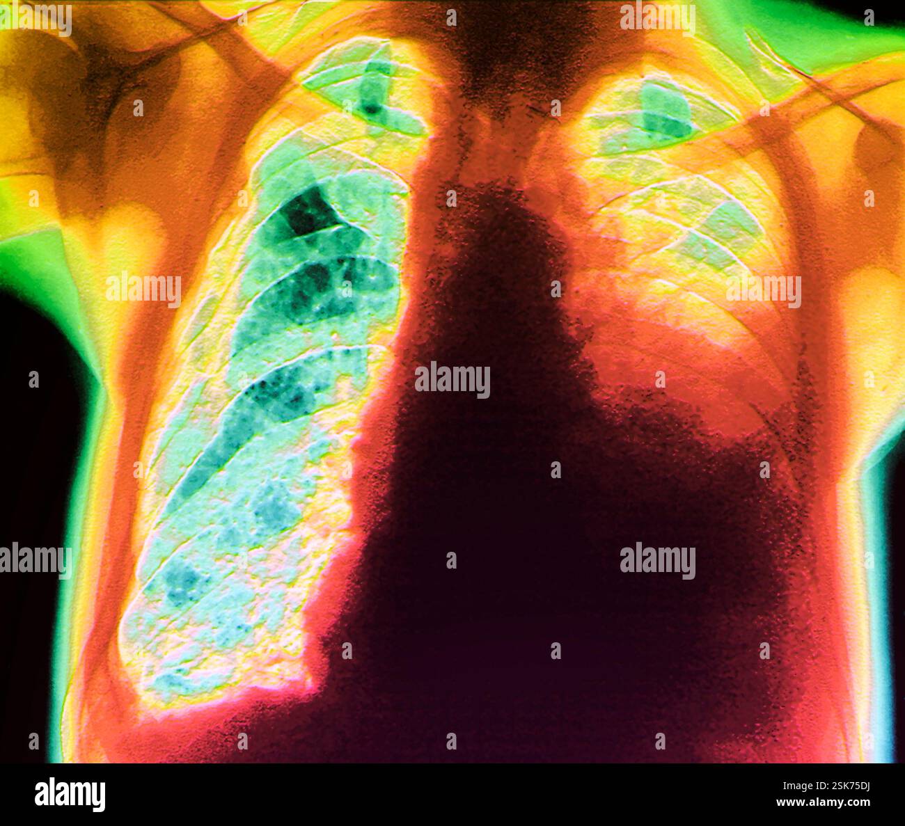 Healthy appendix, barium enema X-ray Stock Photo - Alamy