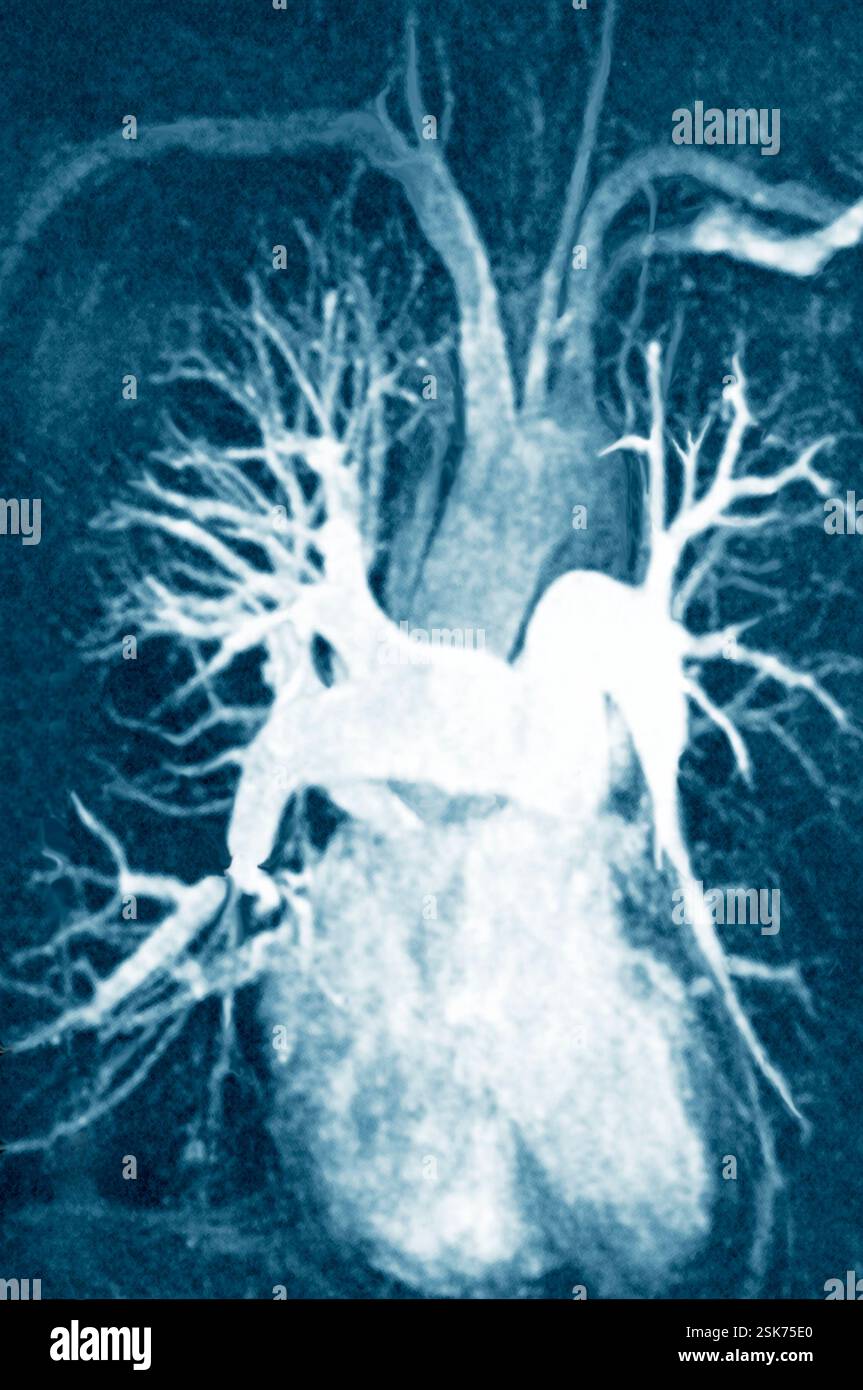 Pulmonary embolism. 3D magnetic resonance angiogram (MRA) scan of a the ...
