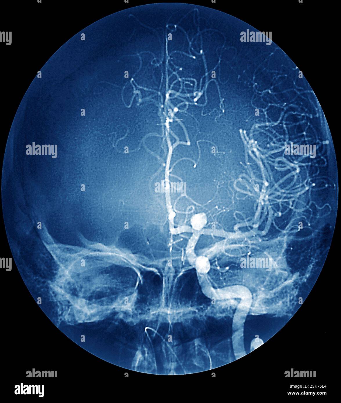 Aneurysms. Coloured angiogram (blood vessel X- ray) of aneurysms (white ...