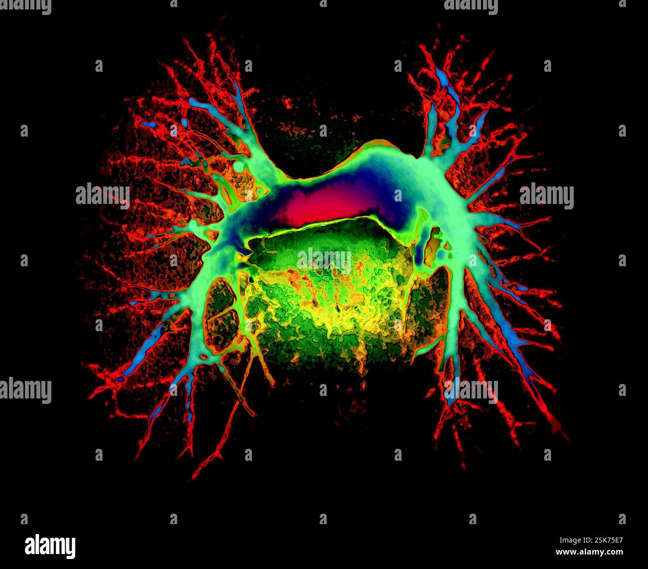 Pulmonary arteries. Coloured frontal 3D magnetic resonance angiogram ...