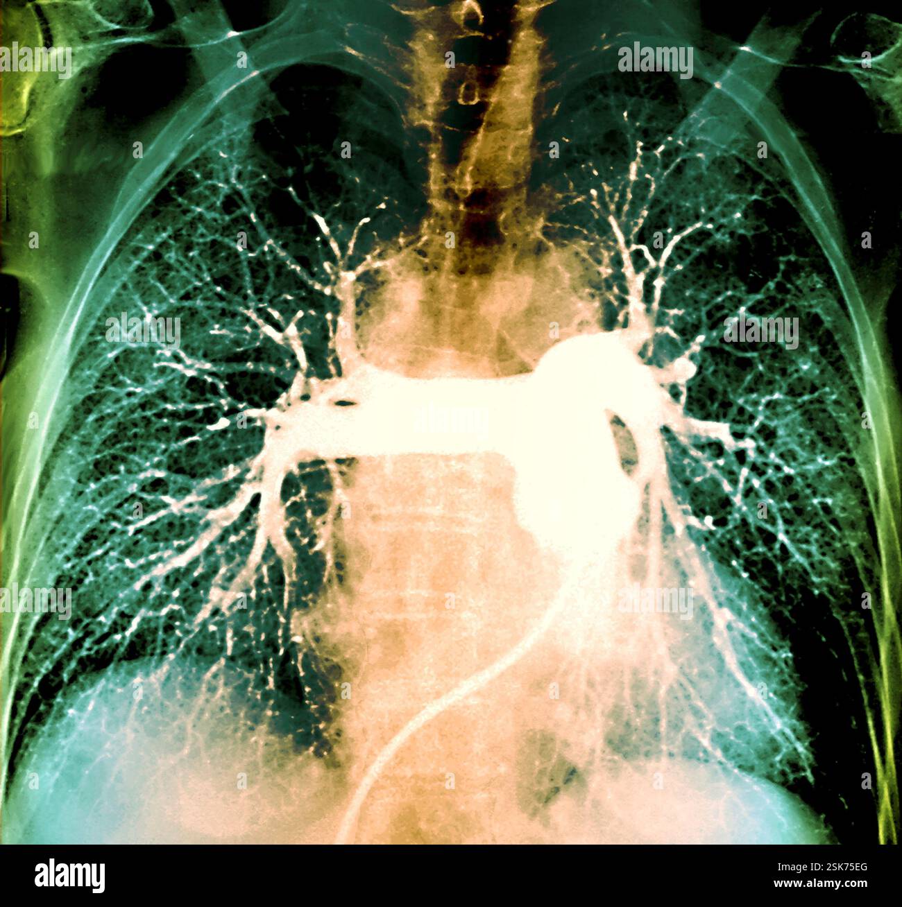 Pulmonary arteries, angiogram Stock Photo - Alamy