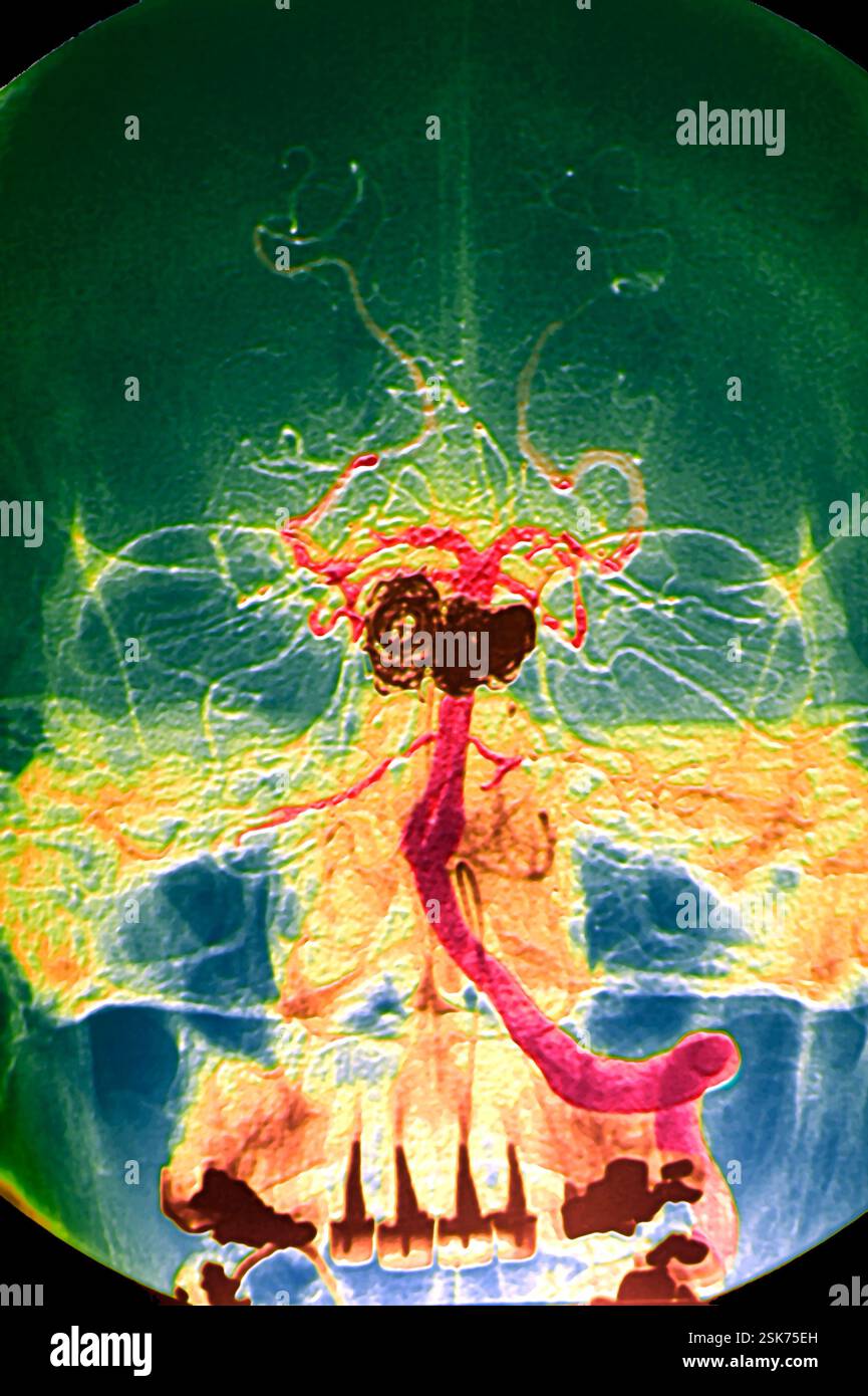 Brain aneurysm treatment. Coloured angiogram (blood vessel X-ray), in ...