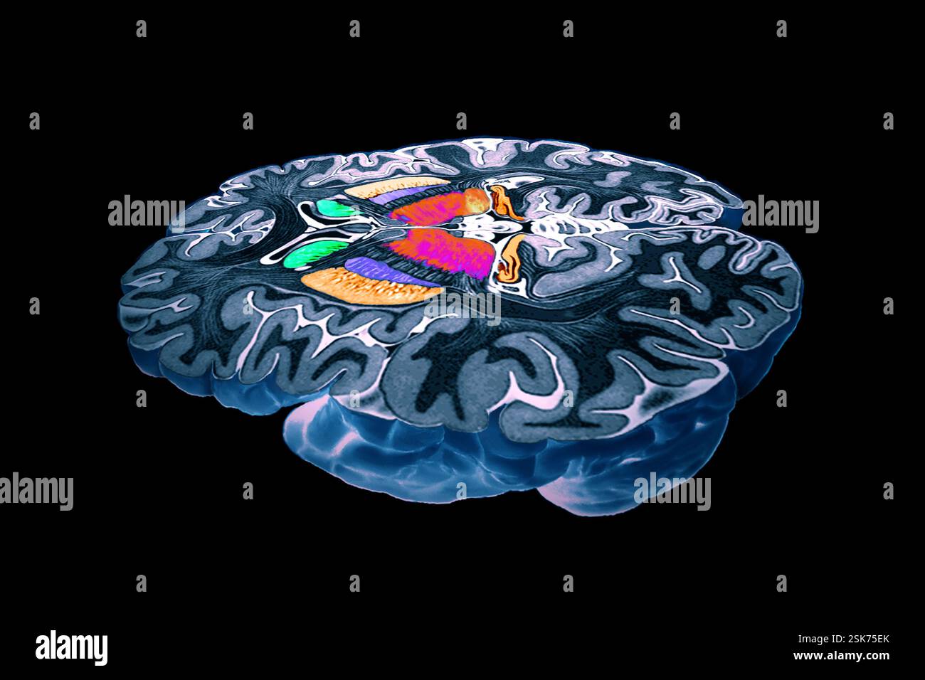 Basal ganglia of the brain, coloured 3-D magnetic resonance imaging (MRI) scan. The brain is ...