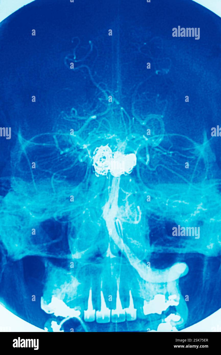 Brain aneurysm treatment. Coloured angiogram (blood vessel X-ray), in ...